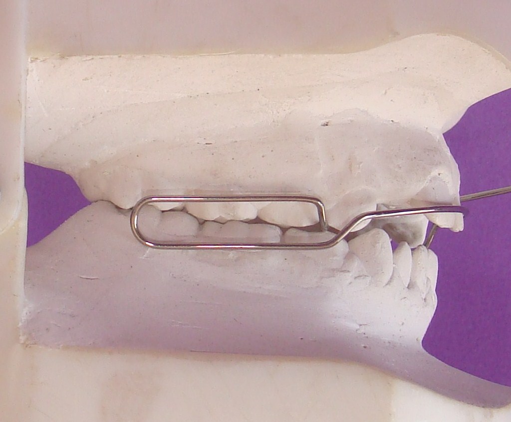 Ortodoncia Tecnica: primer klammt tipo I