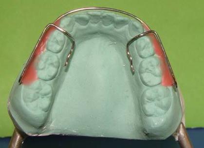 Ortodoncia Tecnica: primer klammt tipo I