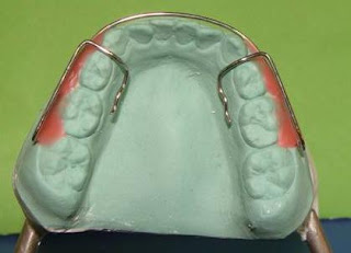 Ortodoncia Tecnica: primer klammt tipo I