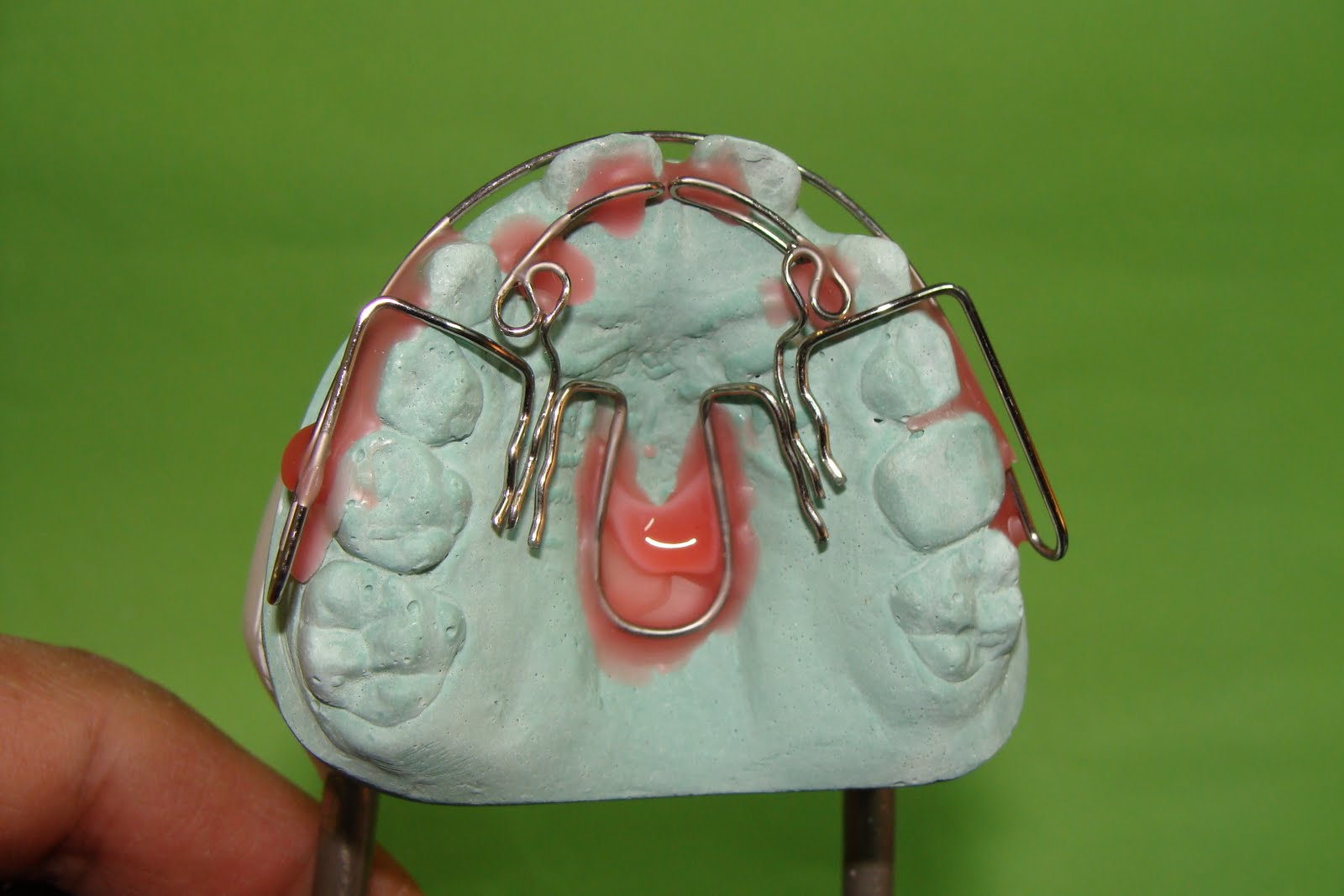 Ortodoncia Tecnica: segundo klammt con escudos retrolabiales