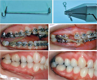 ORTODONTIA CONTEMPORÂNEA: Sliding Jig: confecção e mecanismo de ação