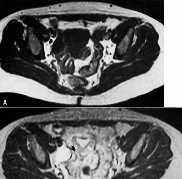 Lacey's MRI and CT pathology: Ovarian cysts