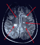 Lacey's MRI and CT pathology: multiple sclerosis