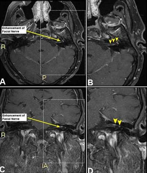 Lacey's MRI and CT pathology: Bell's palsy