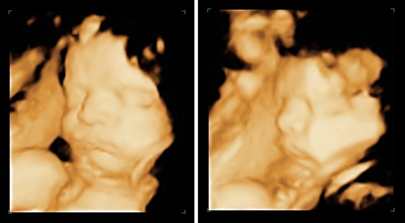 babyFLOCK: week 33: 3D ultrasound