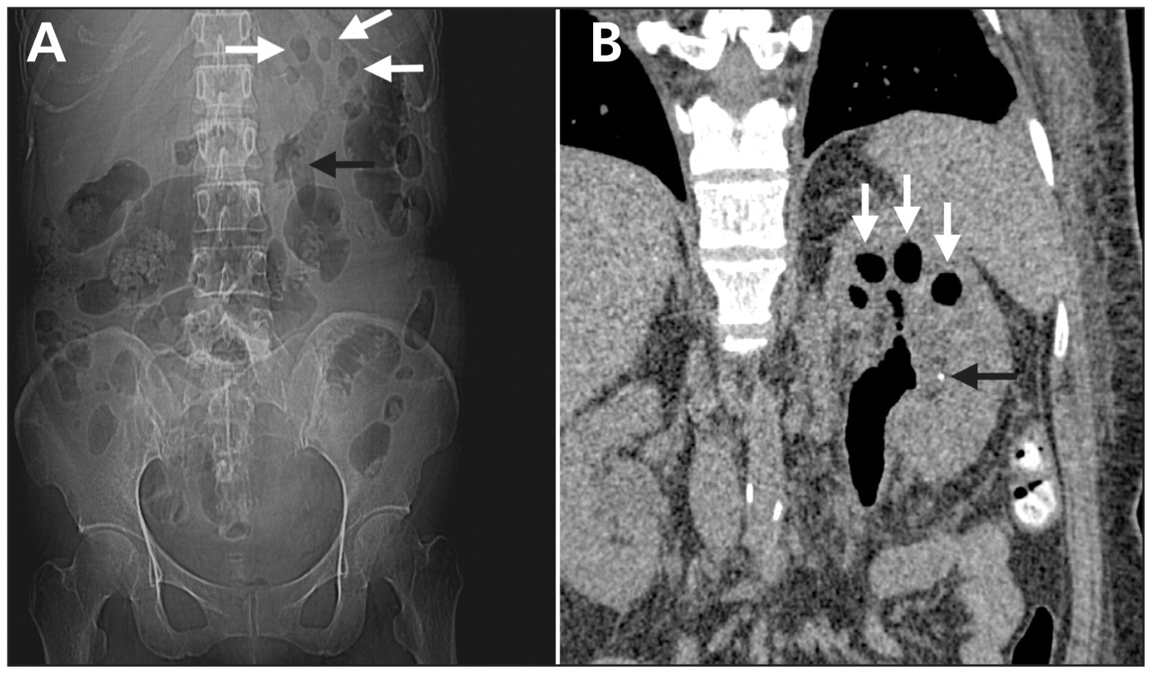 Doctors Gates: A Case of left Flank Pain