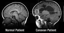 Doctors Gates: Canavan Disease Pic
