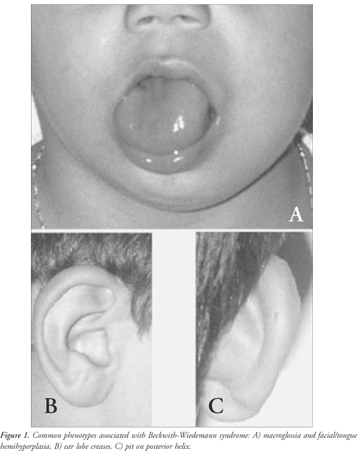 Doctors Gates: Beckwith-Wiedemann Syndrome (BWS)