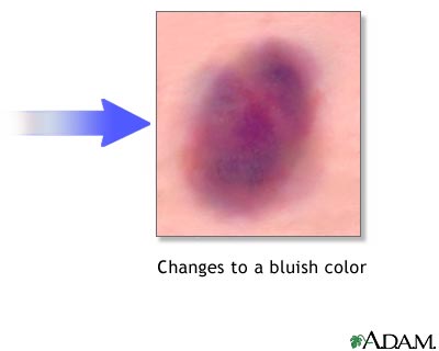 Doctors Gates: Guidelines for color of bruises