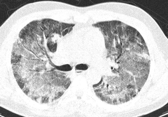 ON - RADIOLOGY: Pneumocystis Carnii-CT