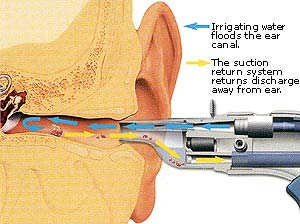 Doctors Gates: Ear Wash System by Welch Allyn