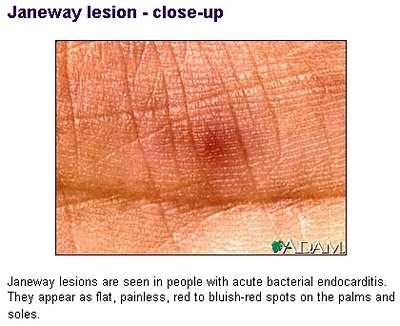 Doctors Gates: Osler's nodes & Janeway lesions