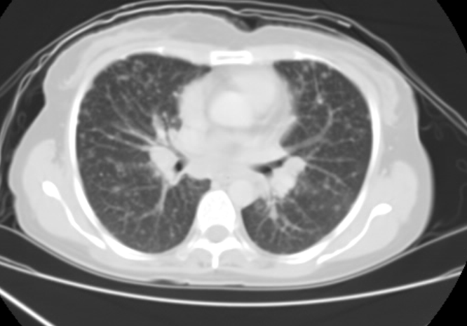 ON - RADIOLOGY: Liver tuberculoma on CT