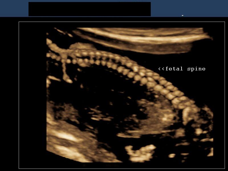 ON - RADIOLOGY: 2-D & 3-D Ultrasound images of normal fetal spine