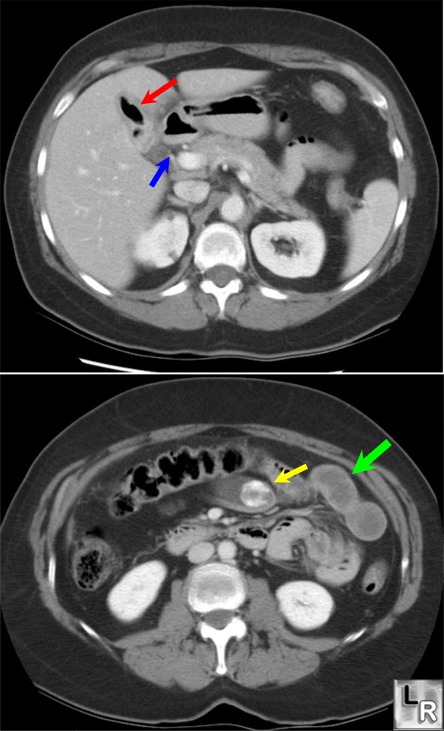 Doctors Gates: Gallstone Ileus in CTand Rigler’s Triad