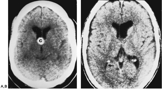 ON - RADIOLOGY: Obstructive hydrocephalus at Level of foramen of Monro
