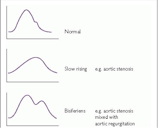 Doctors Gates: Different arterial pulse waveforms and example causes
