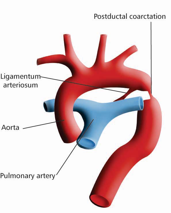 Doctors Gates: Types of Coarctation of the aorta