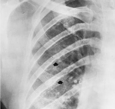 ON - RADIOLOGY: Aortic Coarctation....The most common cause of rib notching