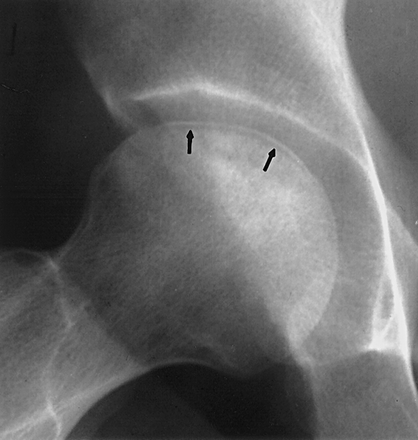 ON - RADIOLOGY: Crescent sign of femoral AVN