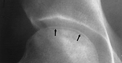 Crescent sign of femoral AVN - Radiology Imaging