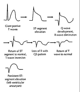Doctors Gates: ECG changes in acute MI