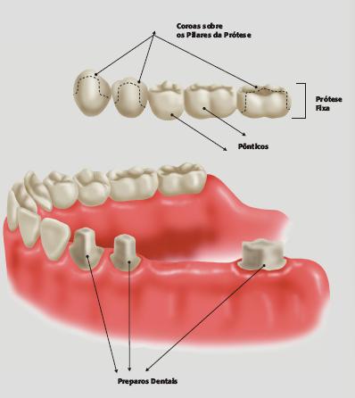 blog do Dr Daniel Nunes: Diferença entre Implante,Prótese Fixa e Faceta ...