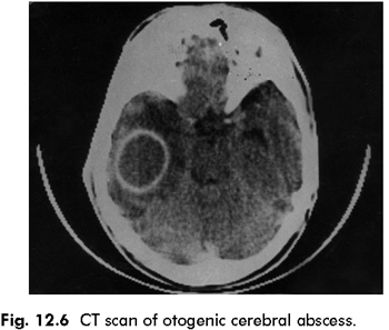 MEDICAL MNEMONICS: Otogenic Brain Abscess : stages