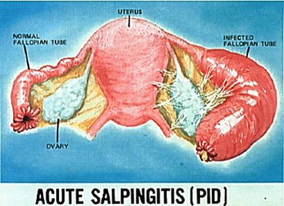 acute salpingitis - meddic