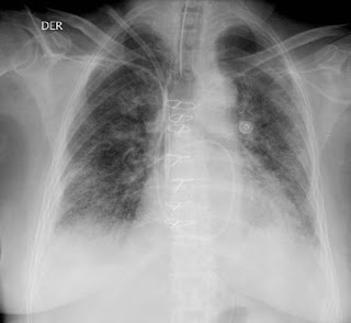 BECADOS RADIOLOGIA HCUCH: Respuesta caso anterior: Traqueomalacia ...