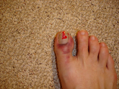 A Great American Hero: Broken Toe