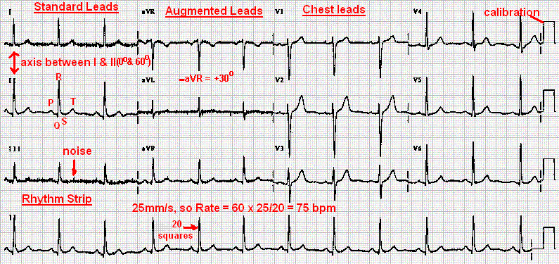 HumBiE: EKG : Normal sinus rhythm