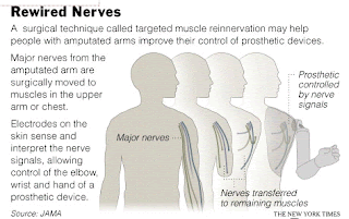 KEEP CURRENT with END THE PAIN PROJECT: Targeted Muscle Reinnervation