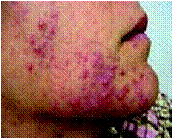 Mumian Seleccion: Que es el Acne