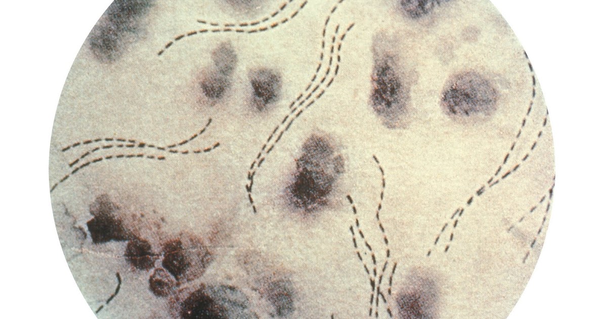 Ciência da Vida: DST: Cancro mole