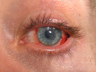 CORNEA TRANSPLANT RECOVERY: THE DAY AFTER THE OP - DAY 1 - 14/10/08