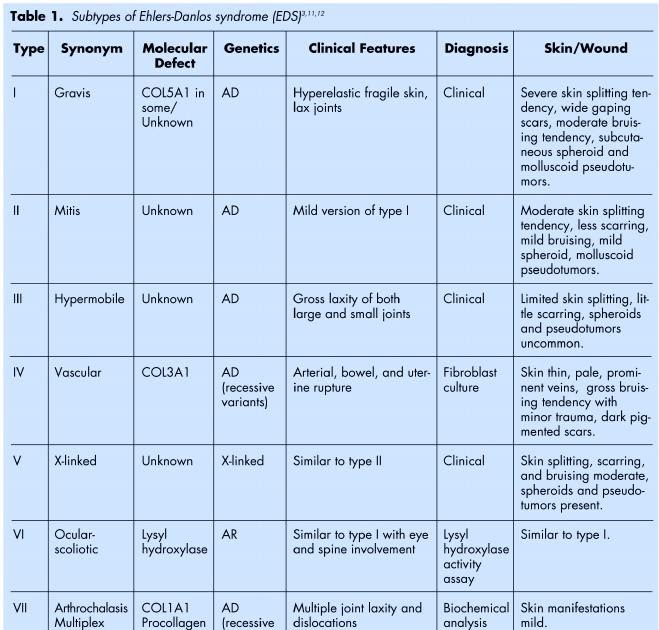 Dance Injury and Ehlers-Danlos Type III Hypermobility Syndrome: EDS ...