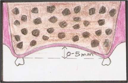 Tania's Dental Projects: A New Classification of Palatal vaults: A ...