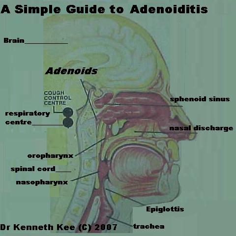 A Family Doctor's Tale: A Family Doctor's Tale - ADENOIDITIS