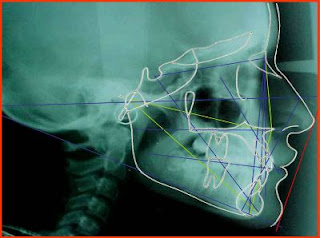 Odontologia en General: Cefalometría