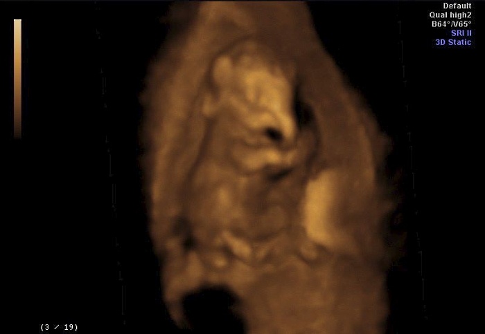 Diário Sertanejo: Ultrassom em 3D mostra feto de elefante