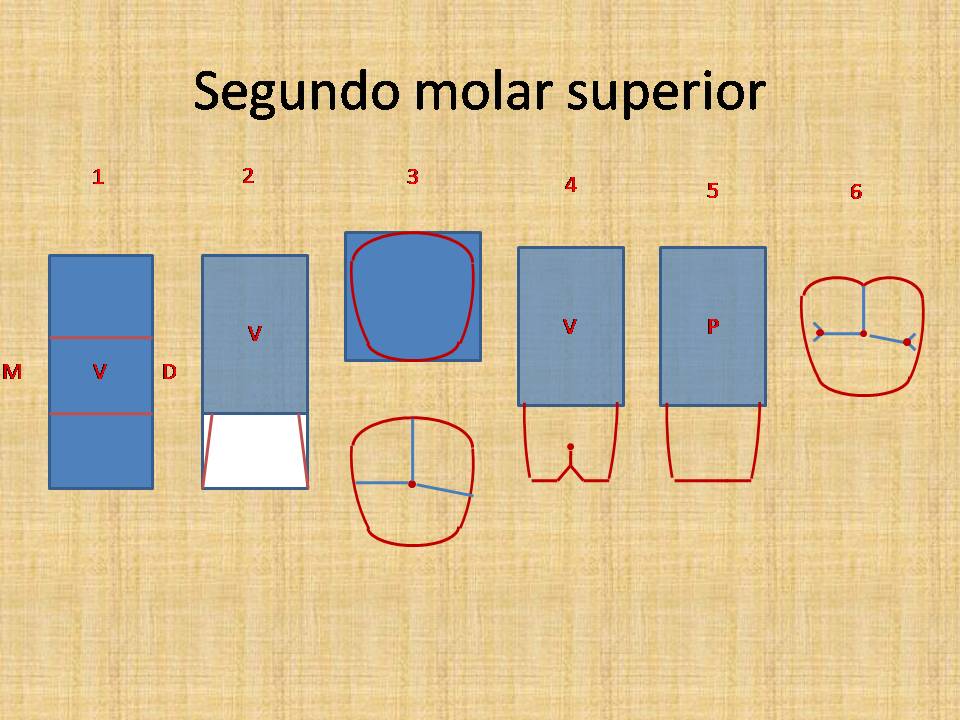 Odontogye: Tallado del segundo molar superior