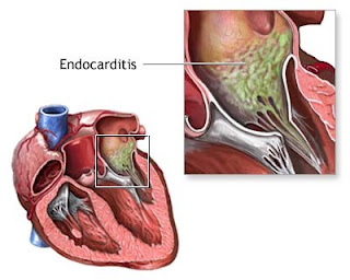 infective endocarditis & its dental prophylaxis..