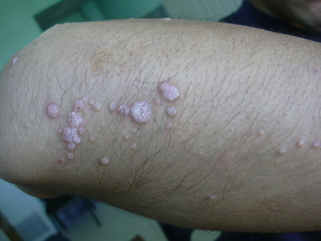 Brógespoter: Verrugas Vulgares