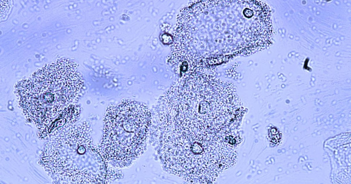 Bacterial Vaginosis Wet Mount