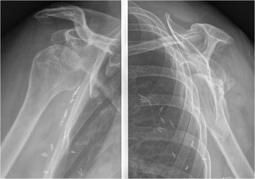 CORACOIDES: Luxacion anterior inveterada