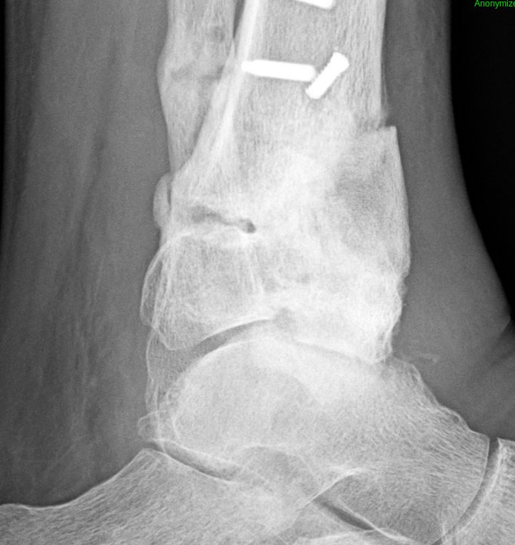 Snowboarder vs. Tree: Ankle X-Rays