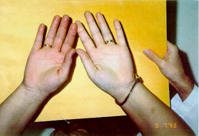 Surgery Mcqs Postgraduation preparation: 29 - white hand sign