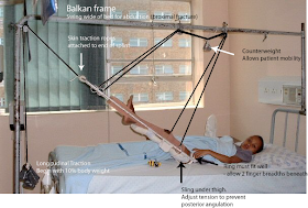Thomas Splint And Pearson Attachment