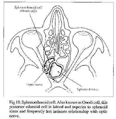 Medical Eponyms with Explanations: 71 - Onodi cell